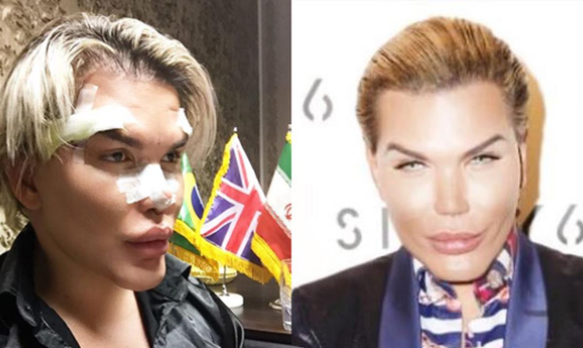 Pese a las advertencias médicas, el "Ken humano" volvió a operarse ...