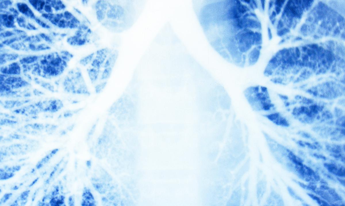 CT, placas de pecho y COVID-19 - Opinión - Primera Hora