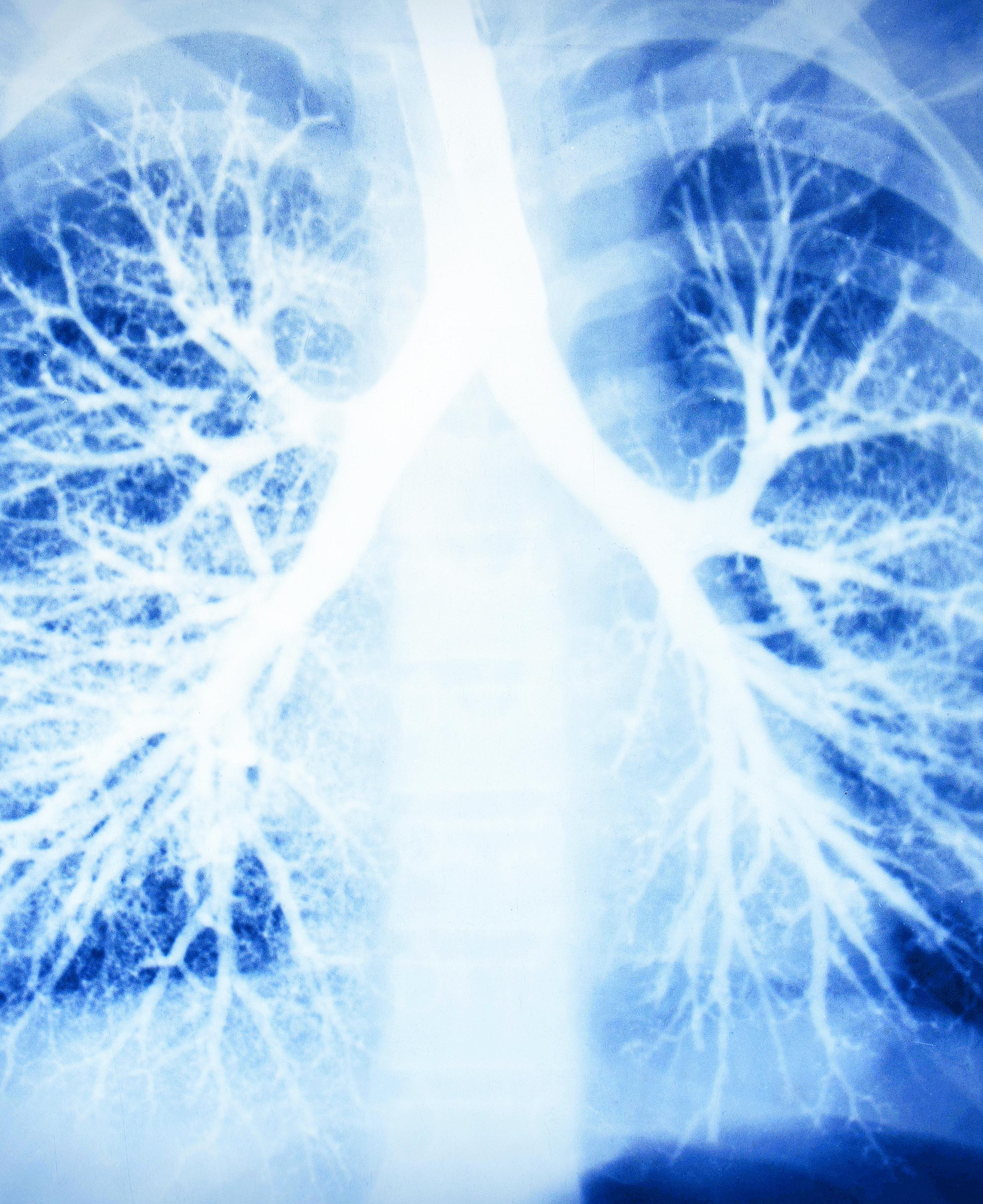 CT, placas de pecho y COVID-19 - Opinión - Primera Hora