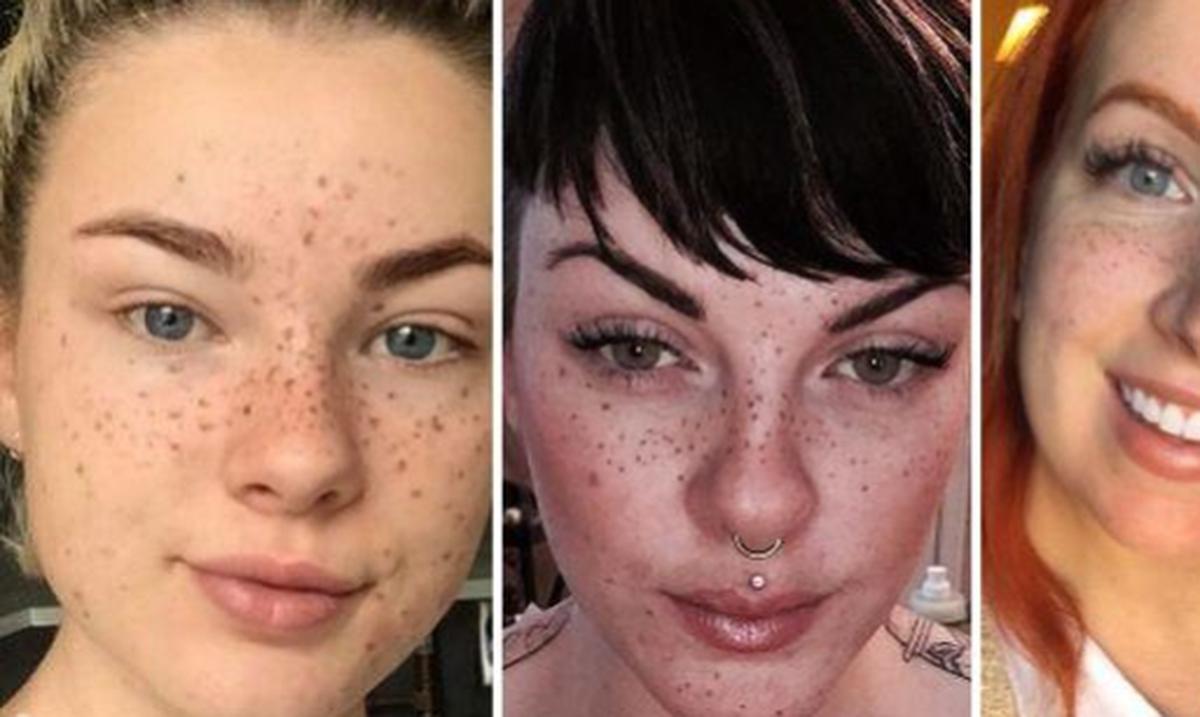 Las pecas están de moda en las redes sociales - Primera Hora