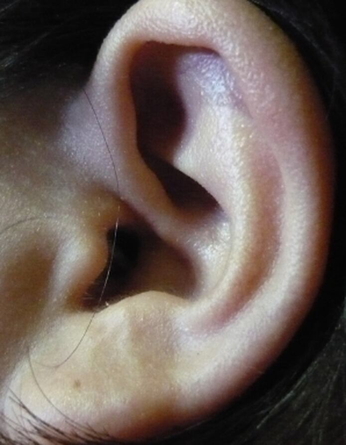 Científicos desarrollan oreja “humana” en el laboratorio - Primera Hora